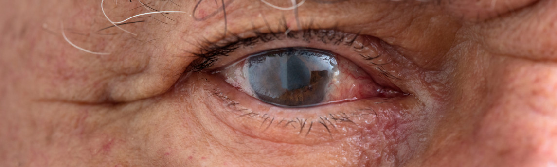 Glaucoma, what are the signs, symptoms and treatments? | Sight Scotland